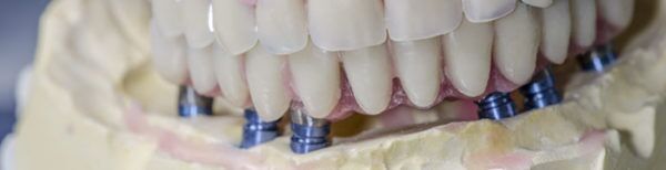 Implants/Hybrid Archives - Ultimate Dental, Denture, Crown & Implants Lab
