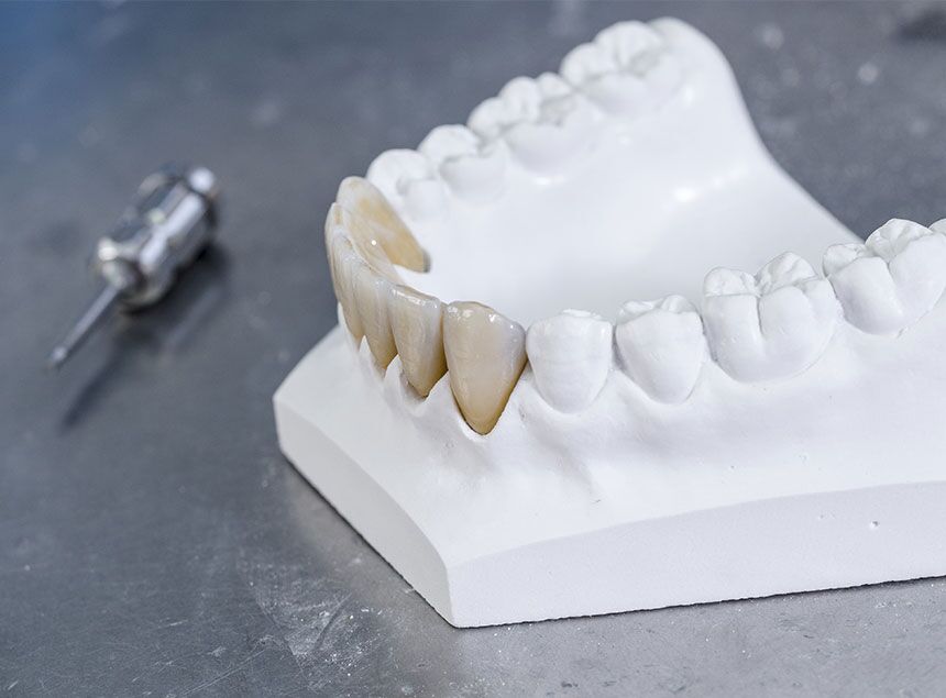 Dental Lab NYC: Ultimate Dental, Denture, Crown & Implants Lab